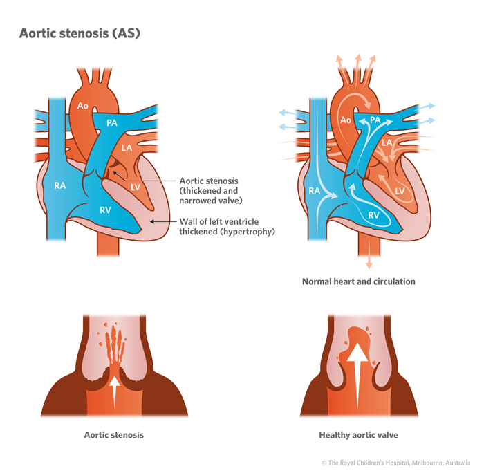 Cardiology Aortic Stenosis