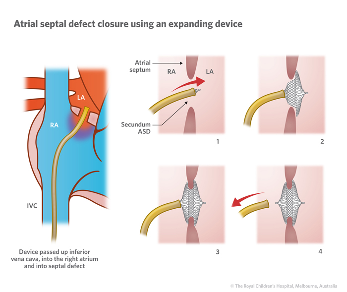 Cardiology Atrial Septal Defect Asd