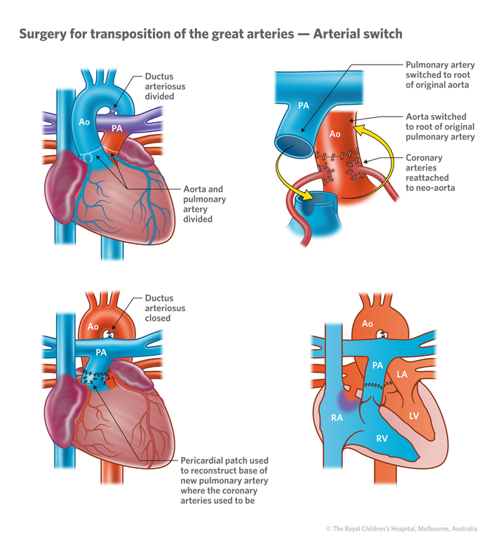 Cardiology : Transposition with VSD