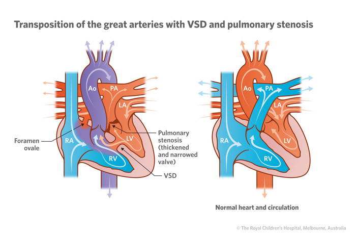 Cardiology : Transposition with VSD