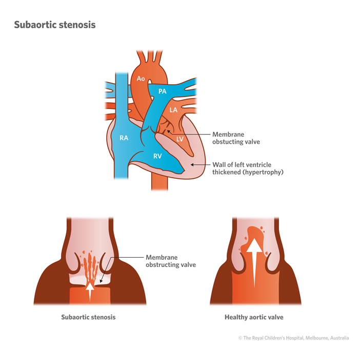 Cardiology Aortic Stenosis AS Cardiology Aortic Stenosis AS