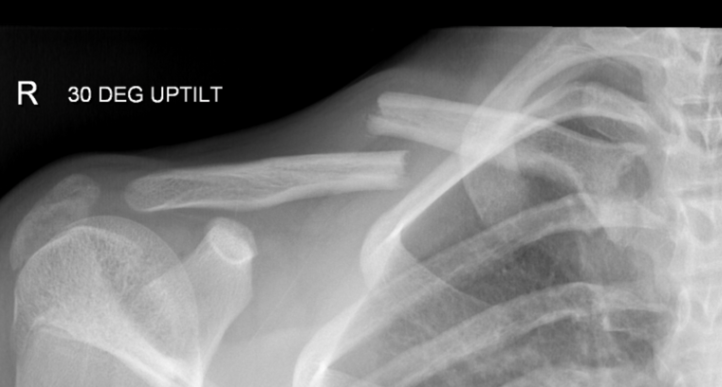 Clavicle Fracture Grosprimary Clavicle Fracture Grosprimary