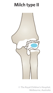 Clinical Practice Guidelines : Lateral condyle fracture of the humerus ...