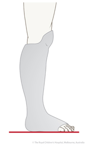 Clinical Practice Guidelines : Tibial shaft (diaphyseal) fracture ...