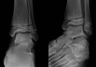 Clinical Practice Guidelines : Distal tibia and-or fibula physeal ...