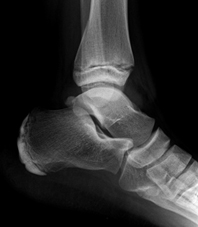 Clinical Practice Guidelines : Distal tibia and-or fibula physeal ...