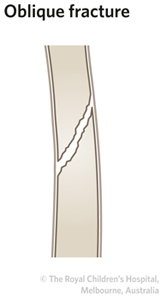 Oblique Fracture