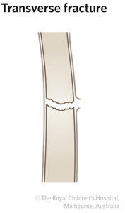 Clinical Practice Guidelines : Femoral shaft fractures - Emergency ...