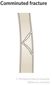 Clinical Practice Guidelines : Femoral shaft fractures - Emergency ...