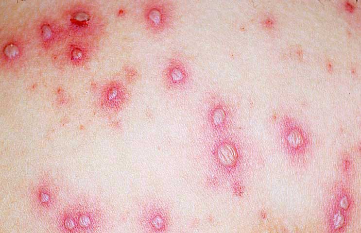 Chicken Pox Rash Day 1