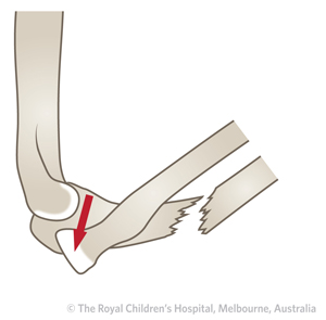 Clinical Practice Guidelines : Monteggia fracture-dislocations ...