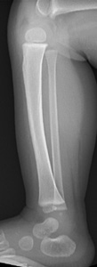 Clinical Practice Guidelines : Tibial shaft (diaphyseal) fracture ...