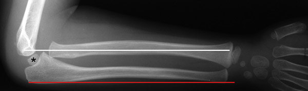 Clinical Practice Guidelines : Radius - ulna shaft diaphysis fractures ...