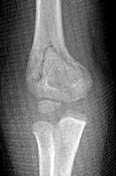 Clinical Practice Guidelines : Supracondylar fracture of the humerus ...