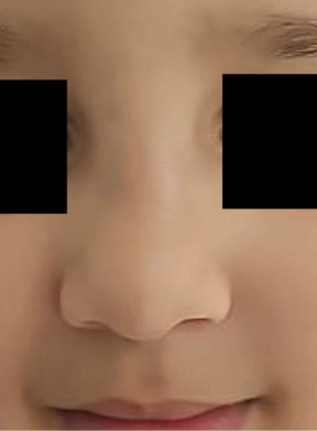 Clinical Practice Guidelines : Nasal fracture