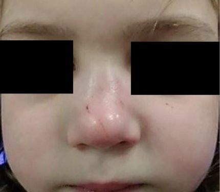 Clinical Practice Guidelines : Nasal fracture