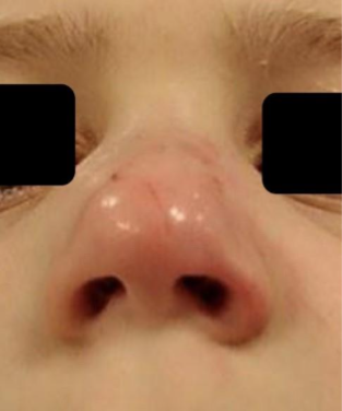 Clinical Practice Guidelines : Nasal fracture