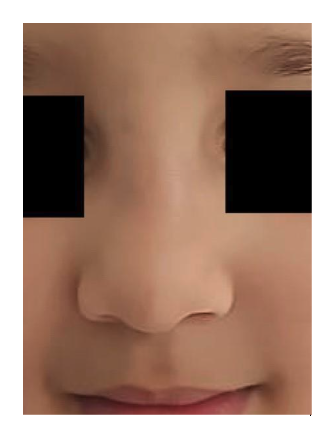 Clinical Practice Guidelines : Nasal fracture