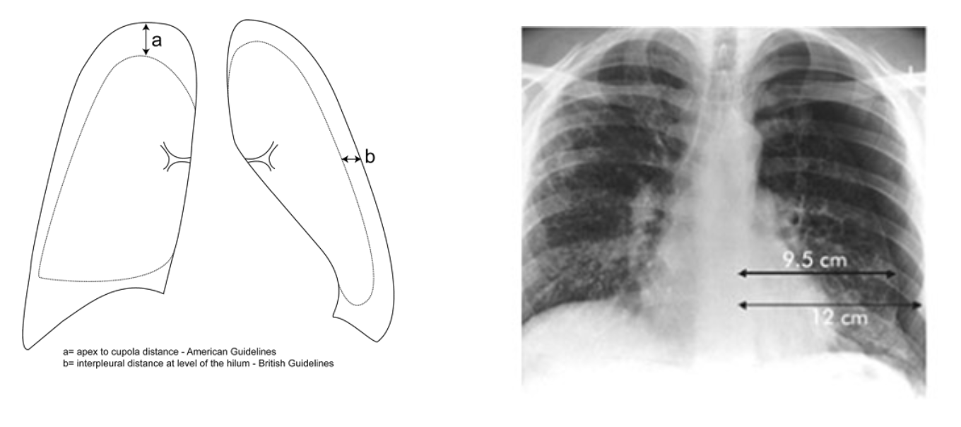 Clinical Practice Guidelines : Primary spontaneous pneumothorax