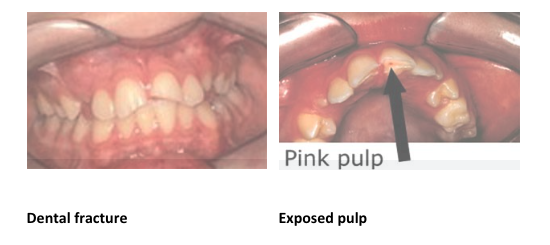Clinical Practice Guidelines : Dental trauma