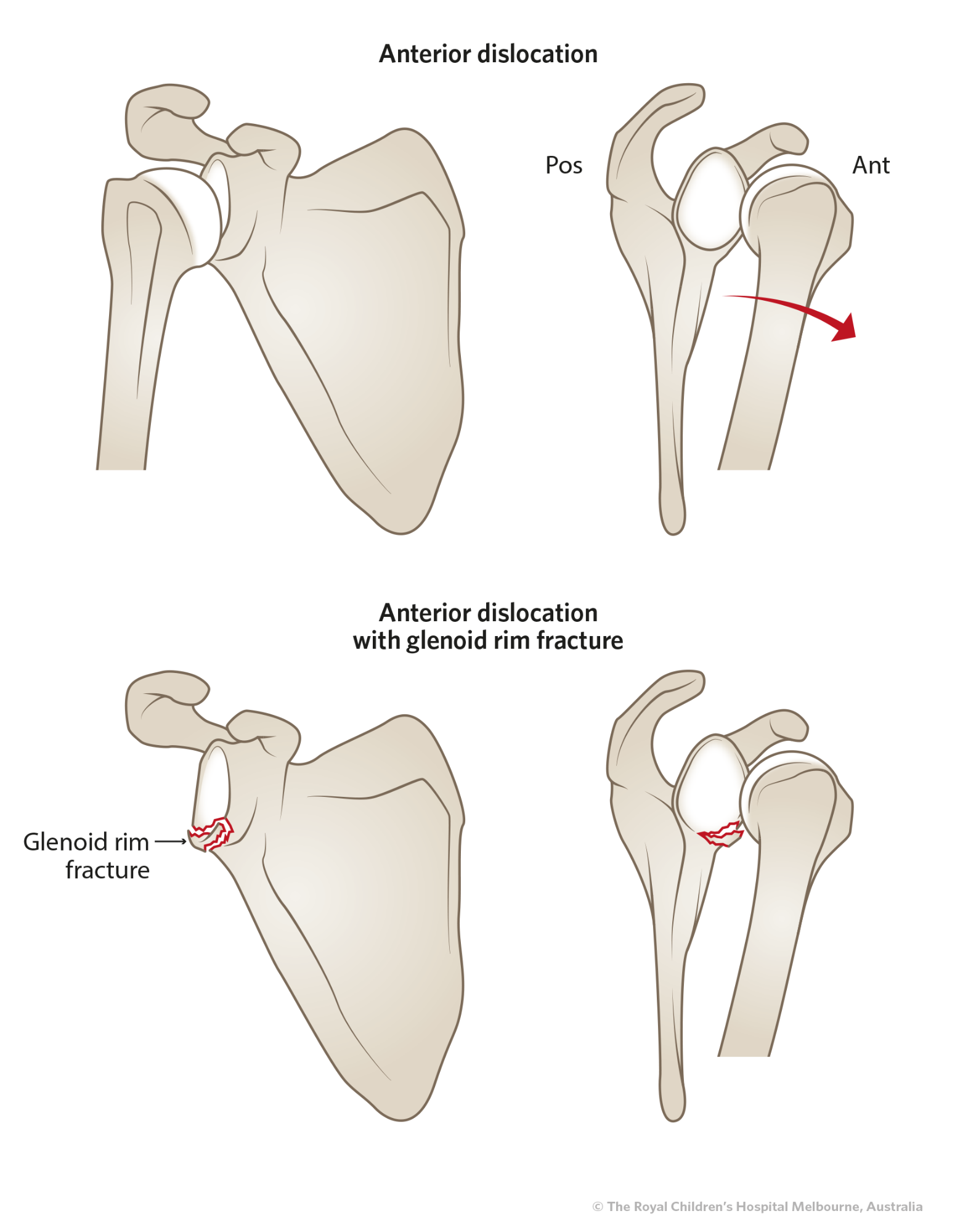Anterior Shoulder Dislocation Anterior Shoulder Dislocation