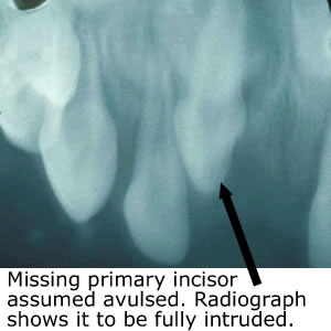 Clinical Practice Guidelines : Dental injuries