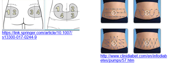 Diabetes at the RCH : Giving an insulin injection