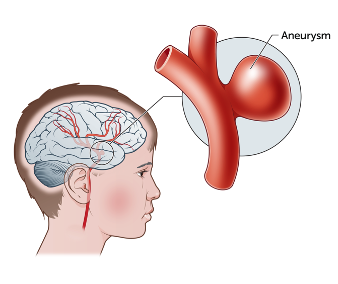 Kids Health Info Cerebral Aneurysm