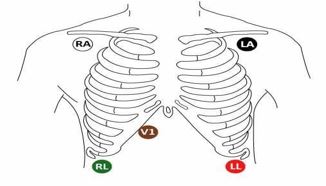 Cardiac Monitor 5 Lead Telemetry Placement