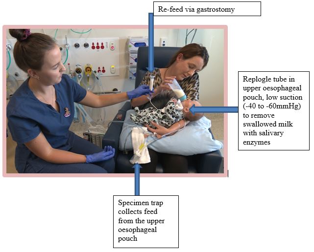 Nursing guidelines : Sham feeding for infants with unrepaired long-gap ...