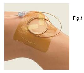 Clinical Guidelines (Nursing) : Wound catheter management