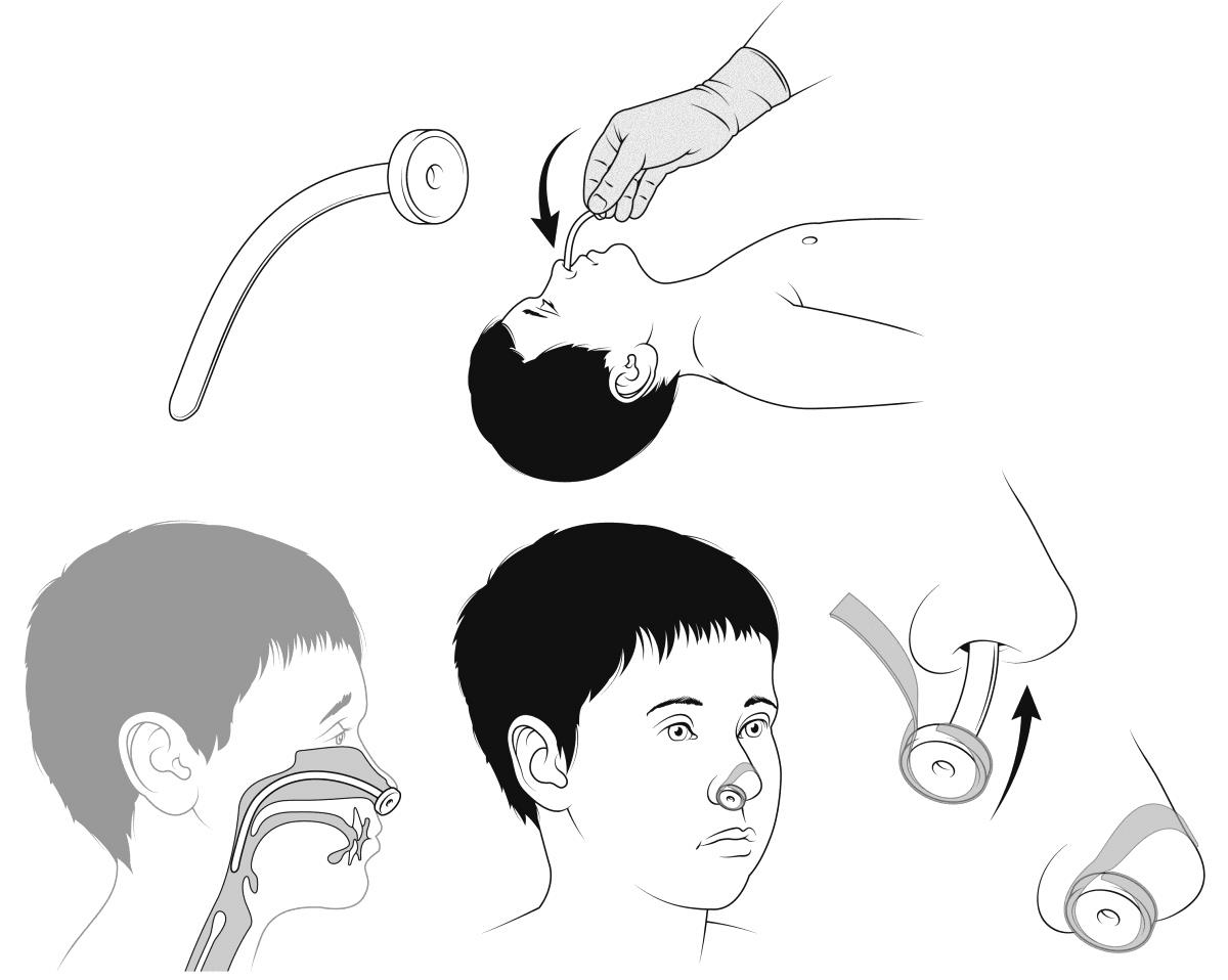Oropharyngeal Airway And Nasopharyngeal Airway