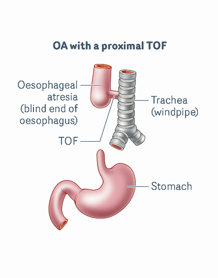 Nursing Guidelines : Replogle tube management
