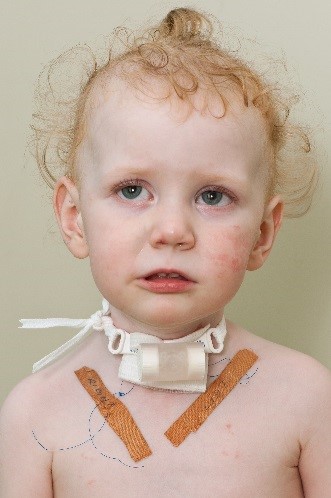 Nursing guidelines : Tracheostomy management