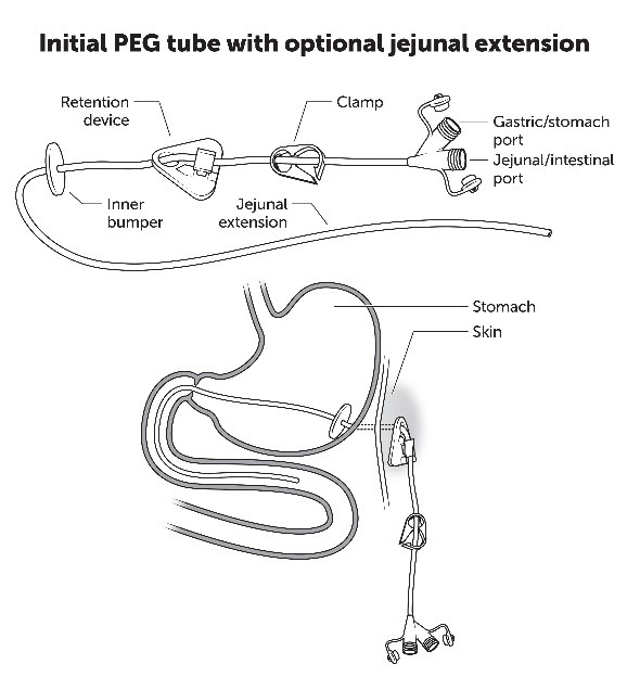 Nursing guidelines : Gastrostomy