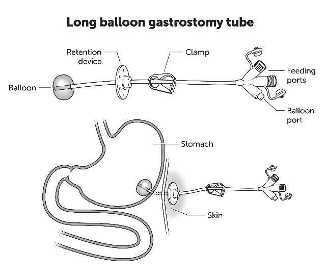 Nursing guidelines : Gastrostomy