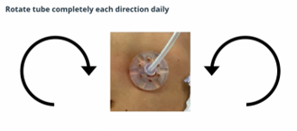 Nursing guidelines : Gastrostomy