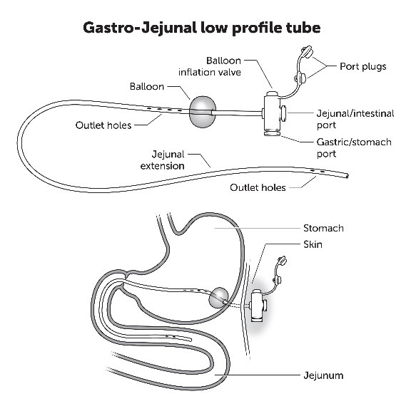 Nursing guidelines : Gastrostomy